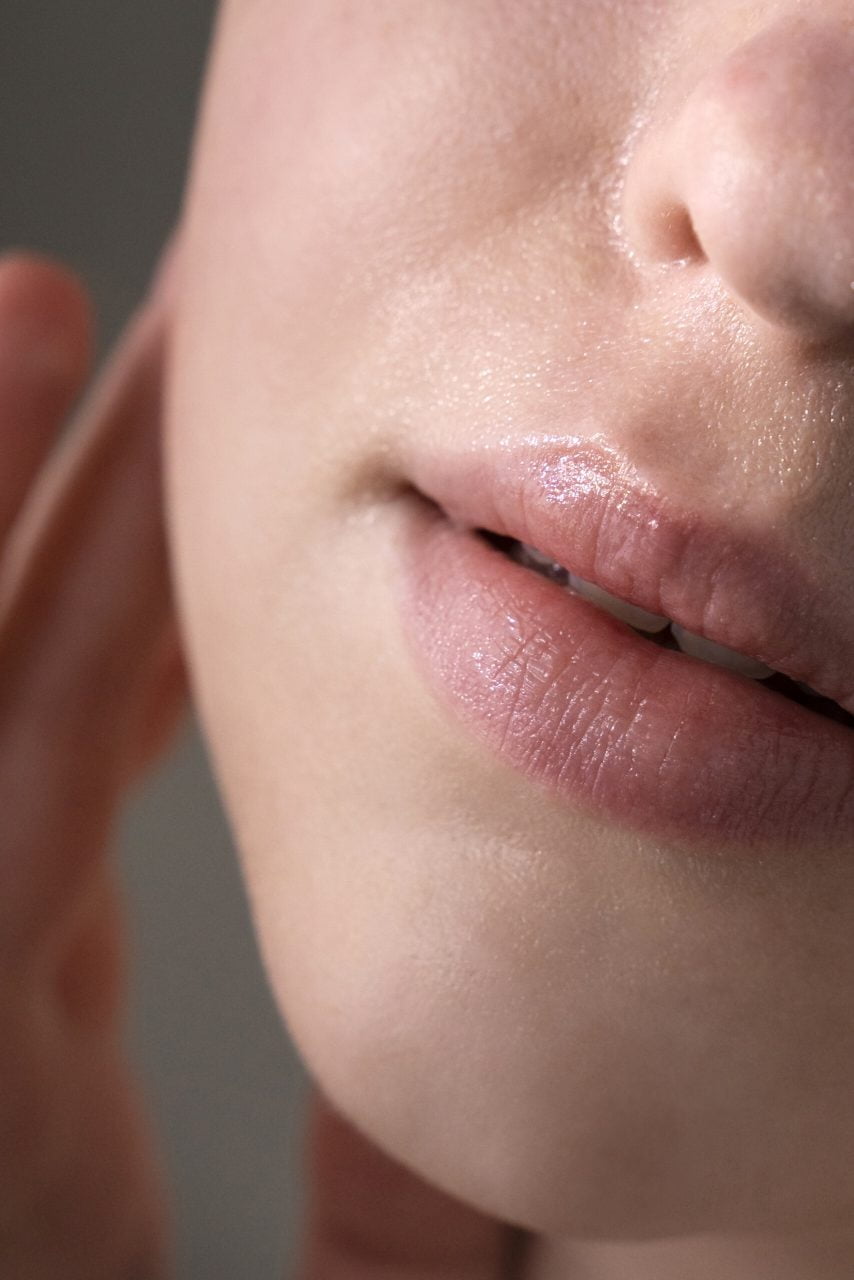Bruising After Lip Filler: What to Expect and How to Minimise Discomfort