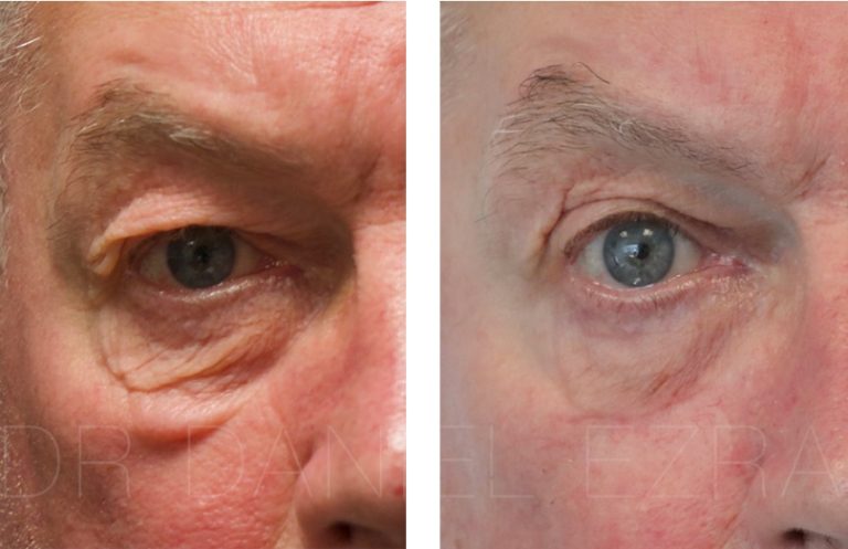 Festoons and malar bags - definition and treatment