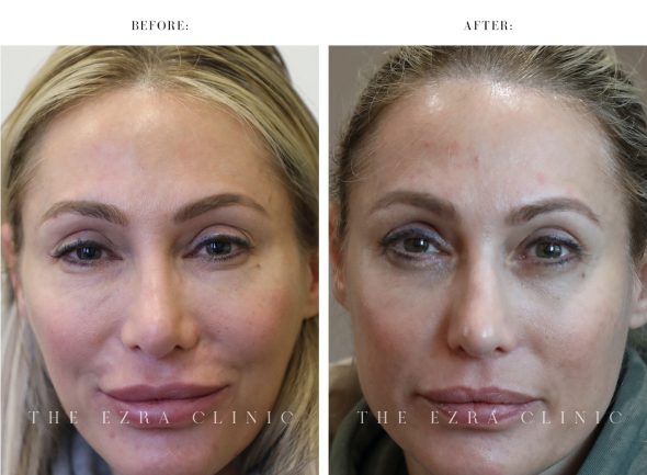 Filler dissolving treatment, complication clinic in London