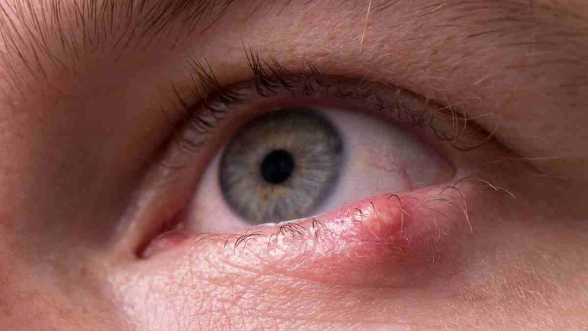 Eye cyst treatment store