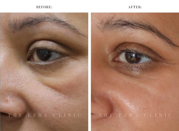 Festoons and malar bags - definition and treatment