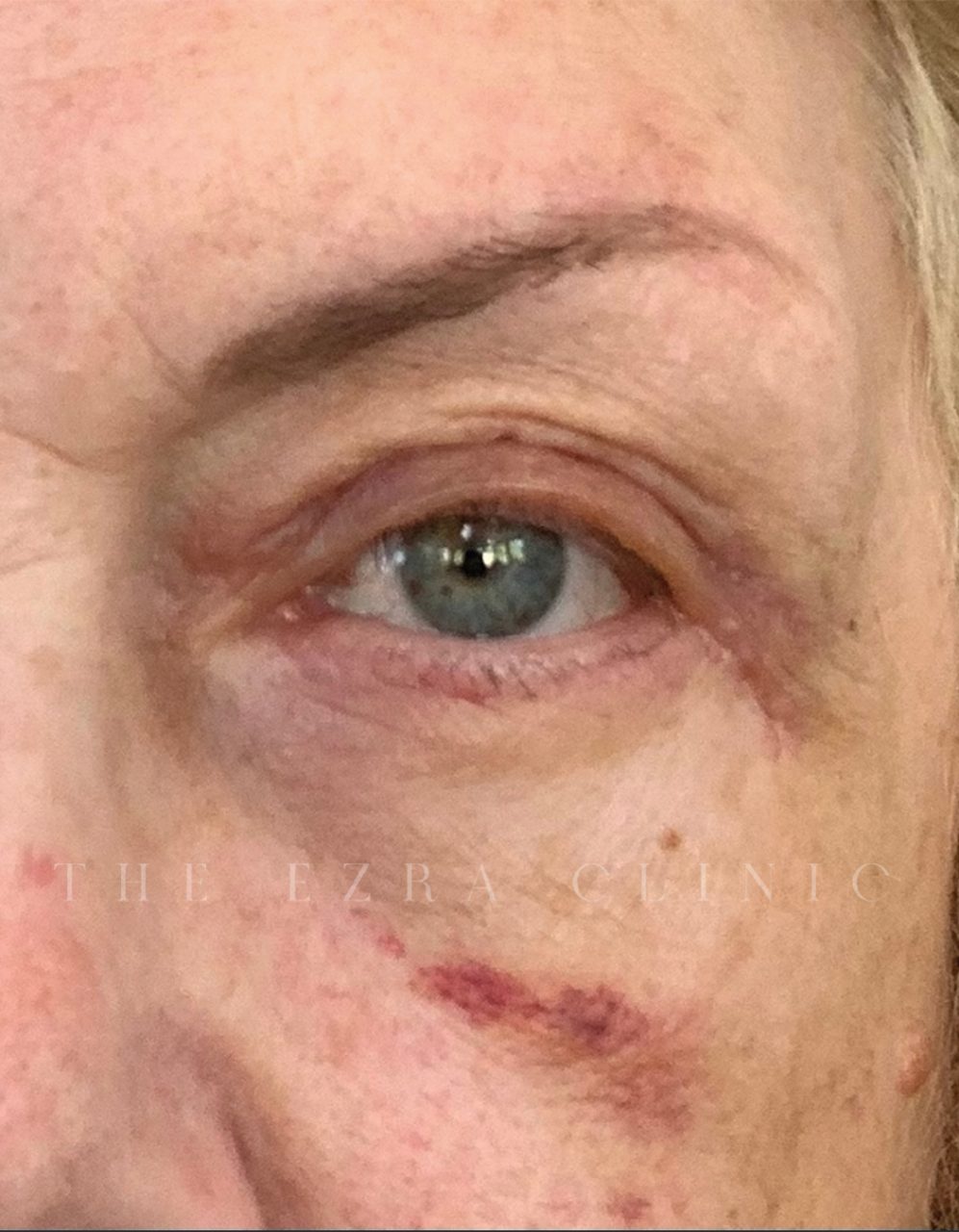 Blepharoplasty London | Eyelid Surgery | Oculoplastic Surgeon